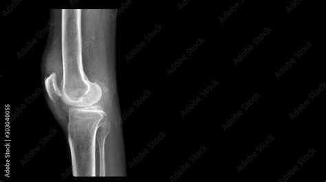 Film X Ray Knee Radiograph Show Os Fabella Fabella Is A Small Bone
