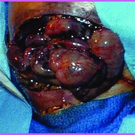 Pdf Necrotizing Enterocolitis