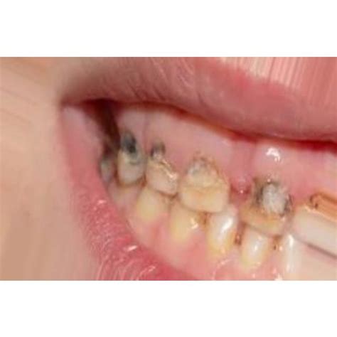 Caries Crowded Calculus Object Detection Dataset By Gigikita