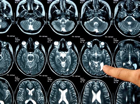 Reversing Age Related Brain Shrinkage Is Easier Than You Think Easy