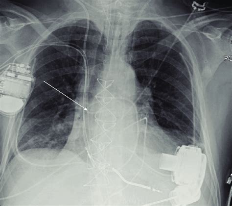 A 61 Year Old Male With Cardiac Failure And Post Lvad Placement