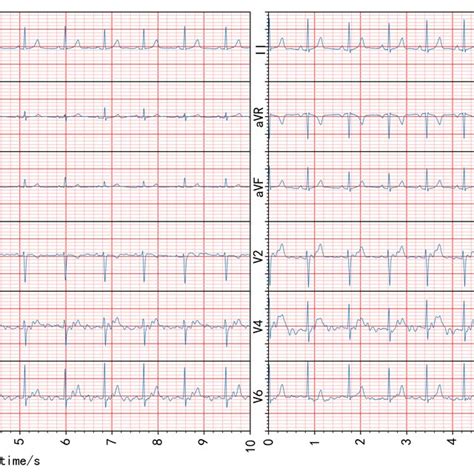Pdf Mlbf Net A Multi Lead Branch Fusion Network For Multi Class Arrhythmia Classification