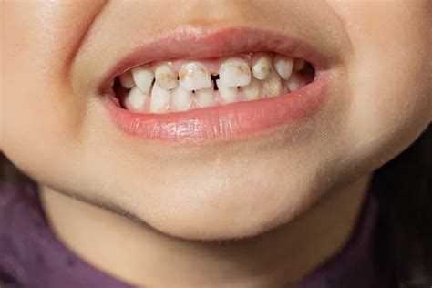 Tooth Decay 5 Reasons Of Why Erdem Hospital And Health Group