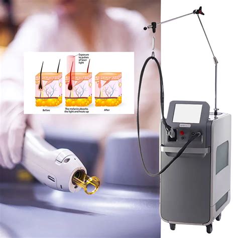 Alexandrite Laser Hair Removal Ebjs