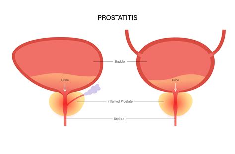 Independent Nurse Diagnosing Acute Bacterial Prostatitis In Primary Care