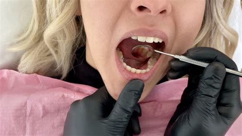 Dental Cleaning Full Mouth And Permanent Retainer Femmefantasy