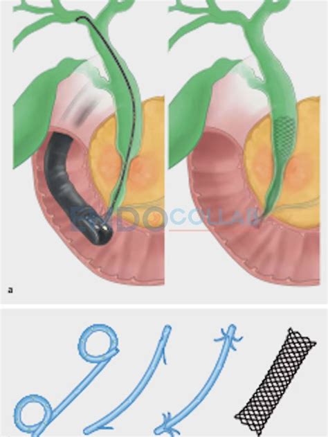 Ercp Series Stents For Pancreatobiliary Strictures Endocollab™ Gi