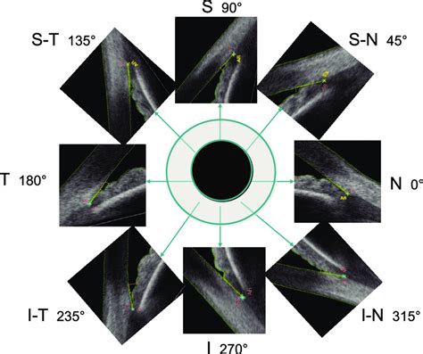 Schematic Explanation Of The Eight Iridotrabecular Angle Sections Under Download Scientific