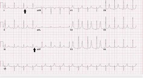 Electrocardiogram Showing Prolonged Qt Interval Black Arrows