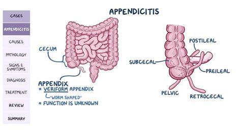 Appendicitis Pathology Review Video And Anatomy Osmosis