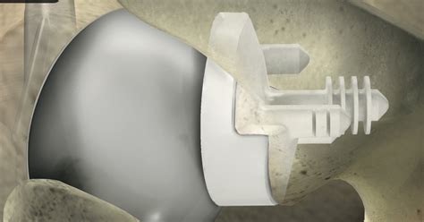 Uw Shoulder And Elbow Academy Augmented Glenoid Components For B2 And