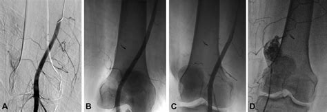 E Right Lower Extremity Angiography And Intervention A Download Scientific Diagram