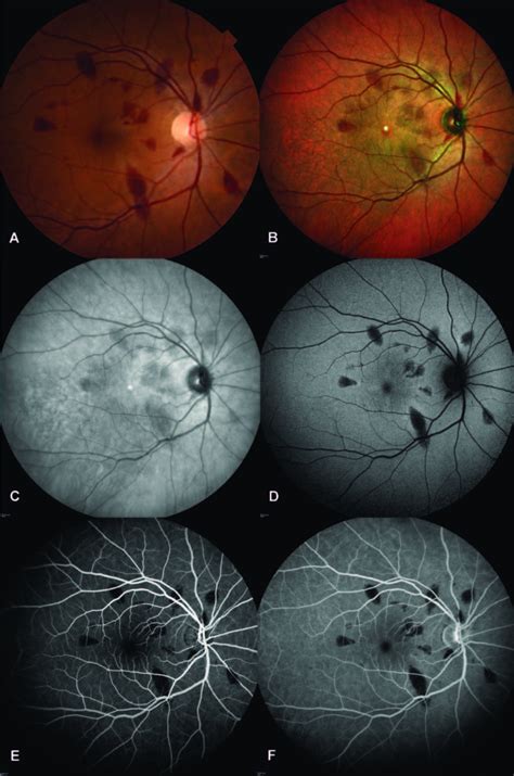 Multimodal Retinal Imaging At Presentation Fundus Image Displaying