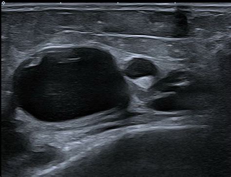 Dr Shimas Adil Salih Al Shammary د شِمْاس عادل صالح الشمري On Linkedin A Large Multilobulated