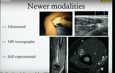 Radial Nerve Injuries Best Evidence —