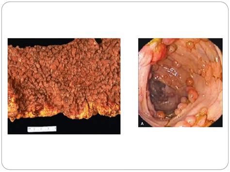 Colonic Polyposis Syndromes Pptx