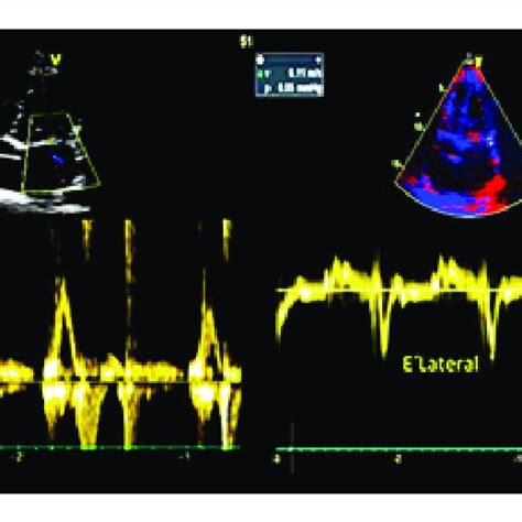 Mitral Flow With Restrictive Pattern Left Td Showing Lateral E´ Download Scientific Diagram