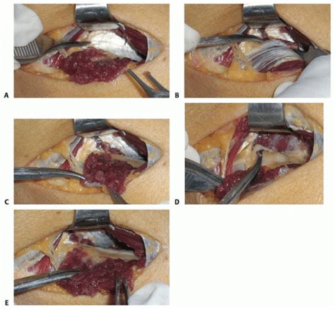 Radial Nerve Decompression Musculoskeletal Key