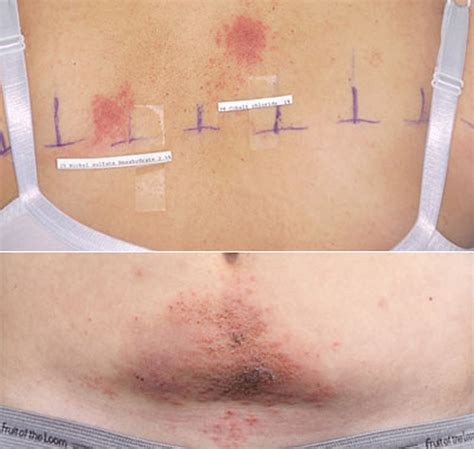 Nickel Allergy Symptoms Foods Test Treatment