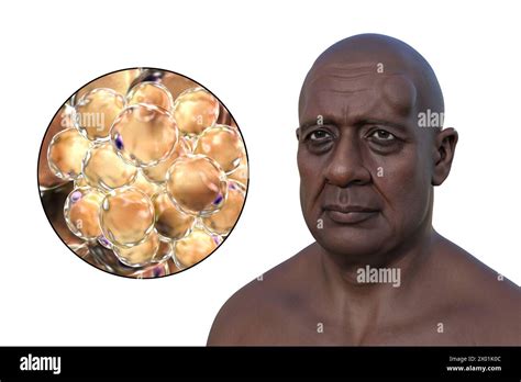 Illustration Of Lipoma On A Mans Forehead And Close Up View Of