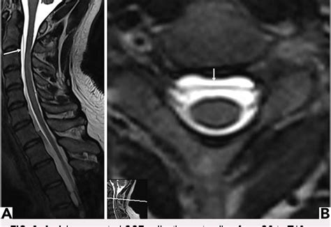 Figure 1 From Symptomatic Interdural Cerebrospinal Fluid Collections After Surgery For