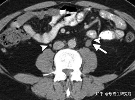 卵巢癌的早中晚期症状都有哪些？ 知乎