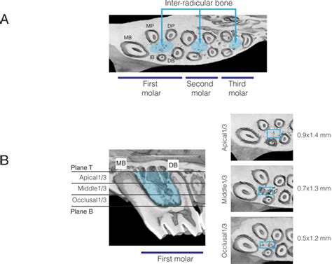 Interradicular Bone