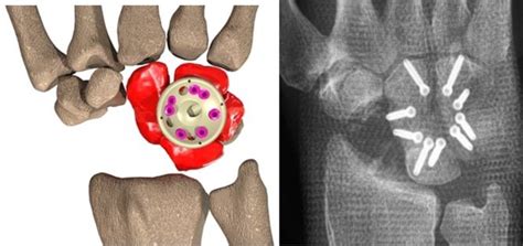 4 Cf Fusion And Scaphoidectomy Download Scientific Diagram
