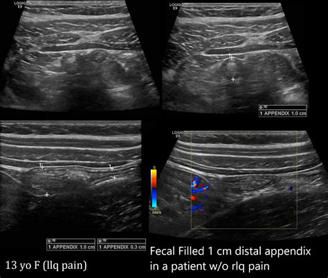 Appendicolith Ultrasound