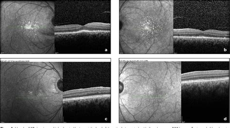 Figure 1 From Ocular Syphilis With Hiv Co Infection Semantic Scholar