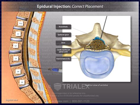 Epidural Injection Correct Placement