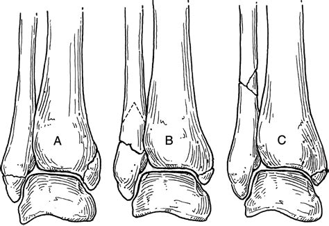 Weber Ankle Fracture Classification