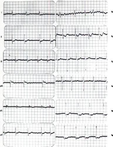 Reversion Of Atrial Fibrillation Following Hyperkalemia Chest