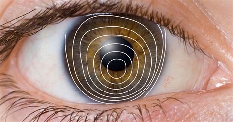 What Are The Most Effective Treatments For Keratoconus Health Cautions