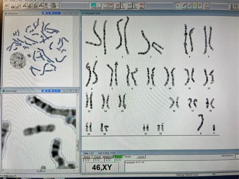 Marieh Khodadadi On Linkedin A Karyotyping Test Is A Laboratory