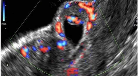 Post Cesarean Delivery Niche Treatment And Prevention Of Csp