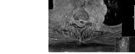 Mri Of The Spine Large Intraspinal Tumor Which Extended To The