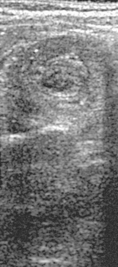Ileus Adhesions Intussusception And Closed Loop Obstructions Clinical Tree