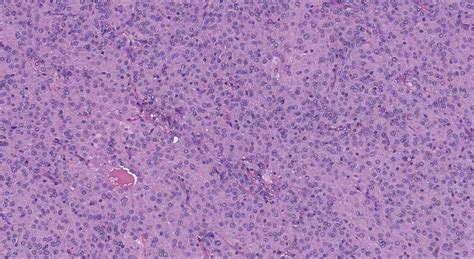 Leydig Cell Tumour Of The Testis Ottawa Atlas Of Pathology