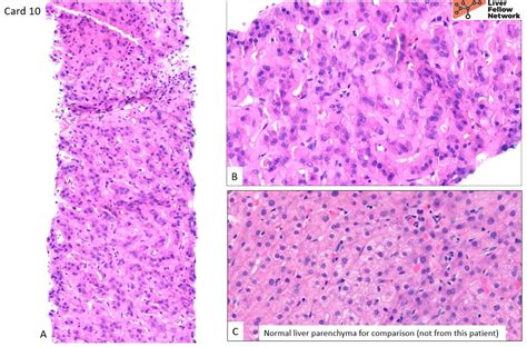 Liver Pathology Aasld