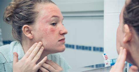 Fibromyalgia Skin Problems How To Cope With Skin Issues Associated