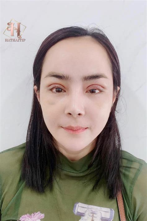 ️ตาสองชั้นกรีดยาว Hathaitip Clinic หทัยทิพย์คลินิก