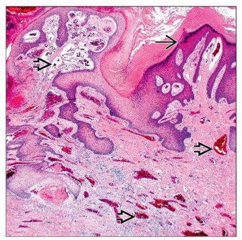 Verrucous Hemangioma Basicmedical Key