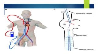 Ecmo Extracorporeal Membrane Oxygenation PPTX First Aid Injuries