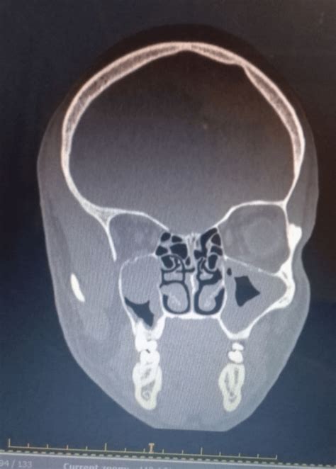 Awaiting Endoscopic Sinus Surgery Rsinusitis