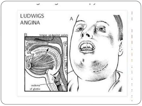 Ludwigs Angina