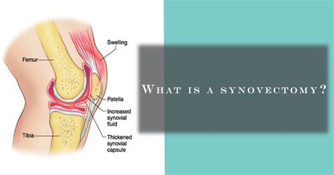 Best Knee Replacement Surgeon Delhi Best Joint Replacement Surgeon Delhi