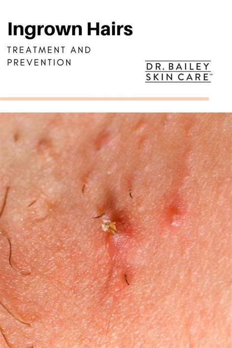 Ingrown Hair Treatment And Prevention Artofit