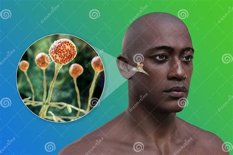 Mucormycosis Of The Middle Ear 3d Illustration Stock Illustration Mucormycosis Of The Middle Ear 3d Illustration Stock Illustration