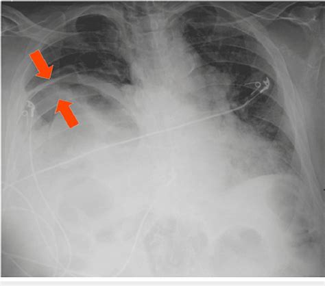 Chest Radiography Shows Marked On Elevation Of The Right Hemidiaphragm